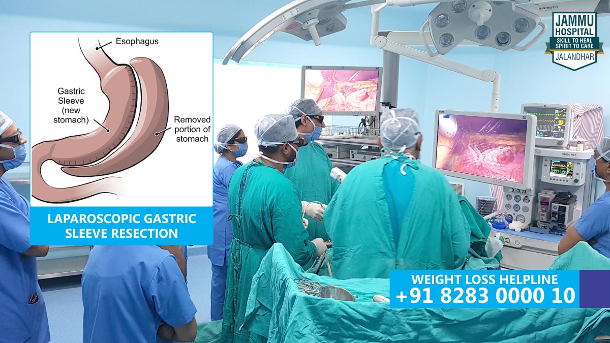Laparoscopic Gastric Sleeve Resection - Bariatric Surgery in Jalandhar ...